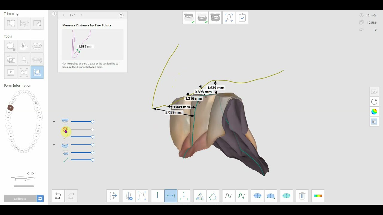 Overbite measurement - YouTube
