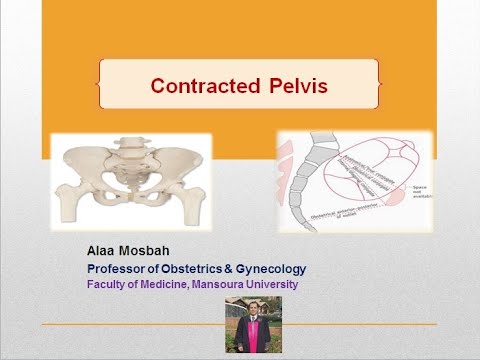 Contracted Pelvis - YouTube
