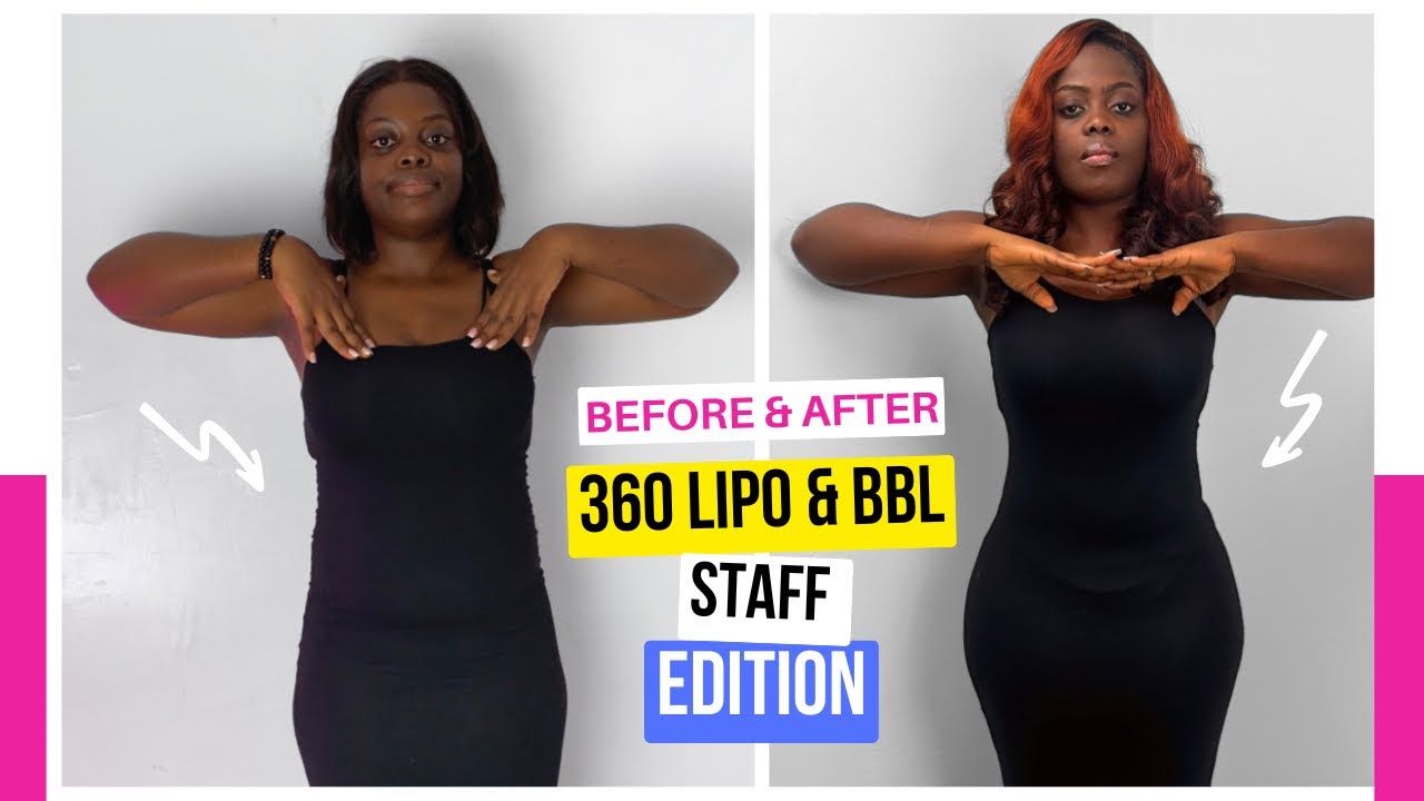 Why our staff got 360 Lipo & BBL | Fears | Dresses | Emotional ...