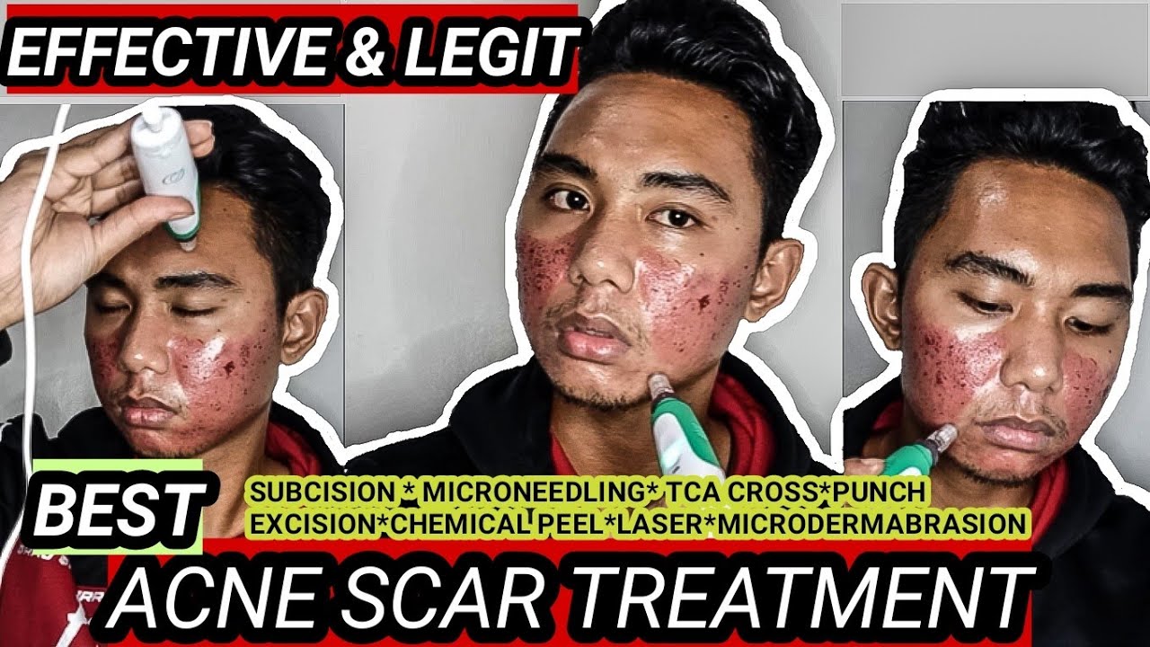 BEST SOLUTION & EFFECTIVE TREATMENT TO REMOVE AND GET RID OF ACNE SCARS ...