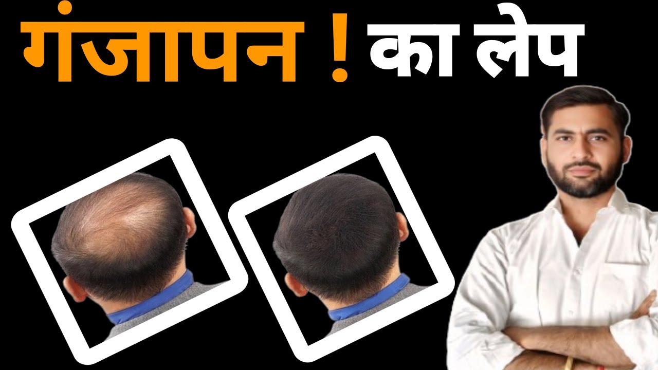 गंजापन का लेप | Hair Regrowth Formula In Home Made | Home Remedy For ...