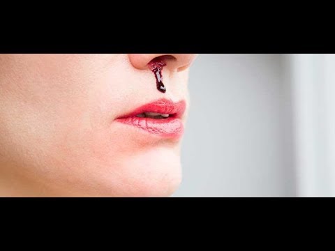 Afya Yako: Mambo yanayosababisha damu kutoka puani