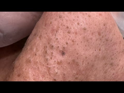 Ultimate Blackhead Removal Routine | Total Pore Cleansing