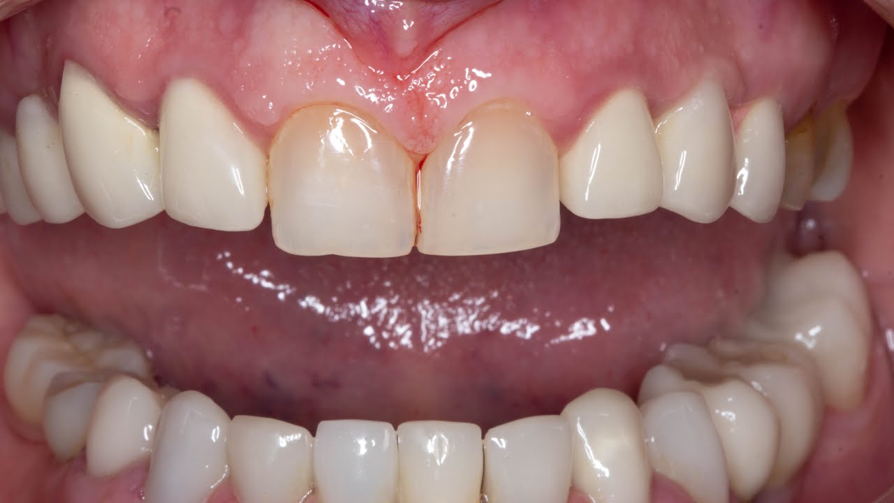 Gum retraction , preparation of Teeth for veneers , preparation of ...