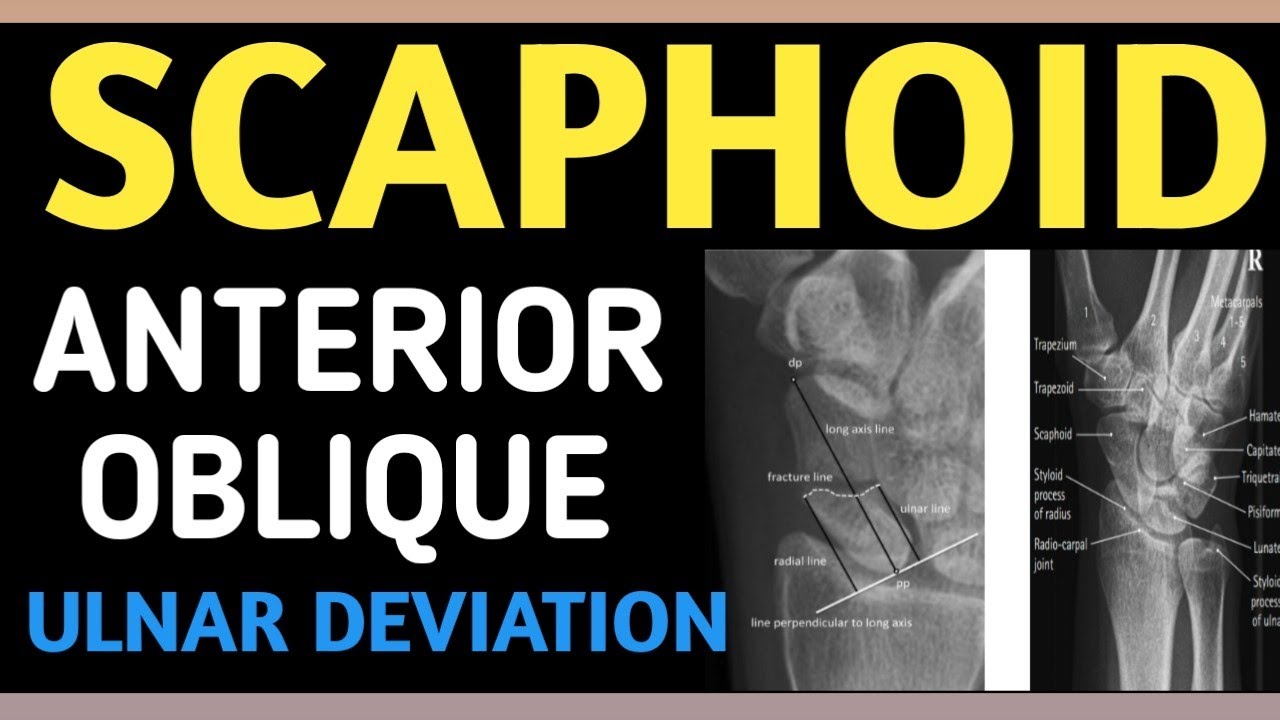 Scaphoid Anterior oblique ulnar deviation ( scaphoid projection with ...
