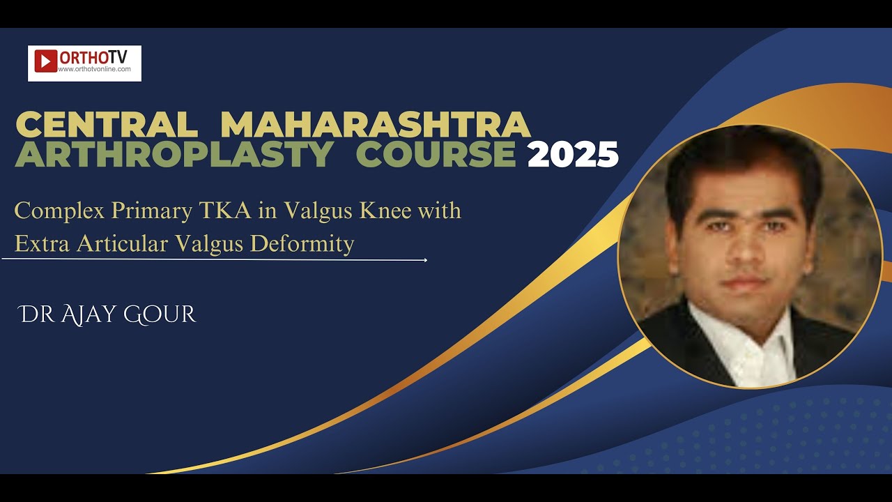 Complex Primary TKA in Valgus Knee with Extra Articular Valgus ...