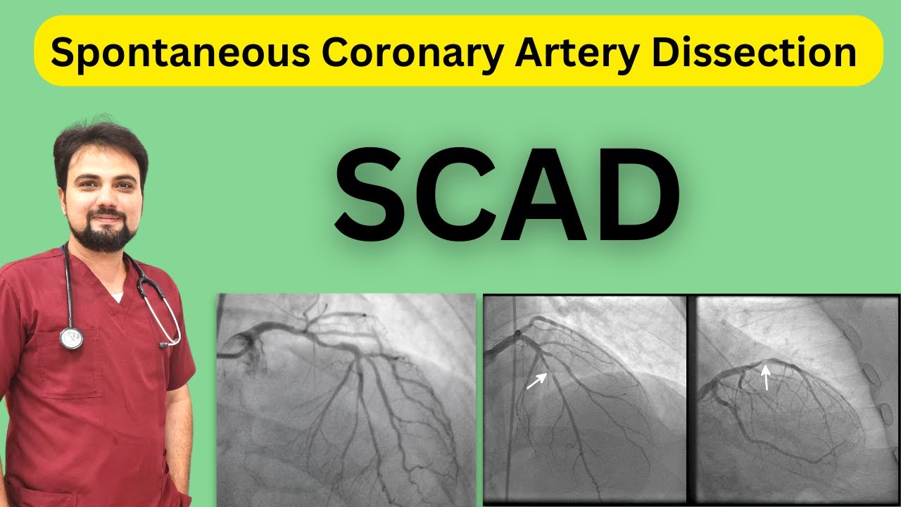 What Is Spontaneous coronary artery dissection?SCAD - YouTube