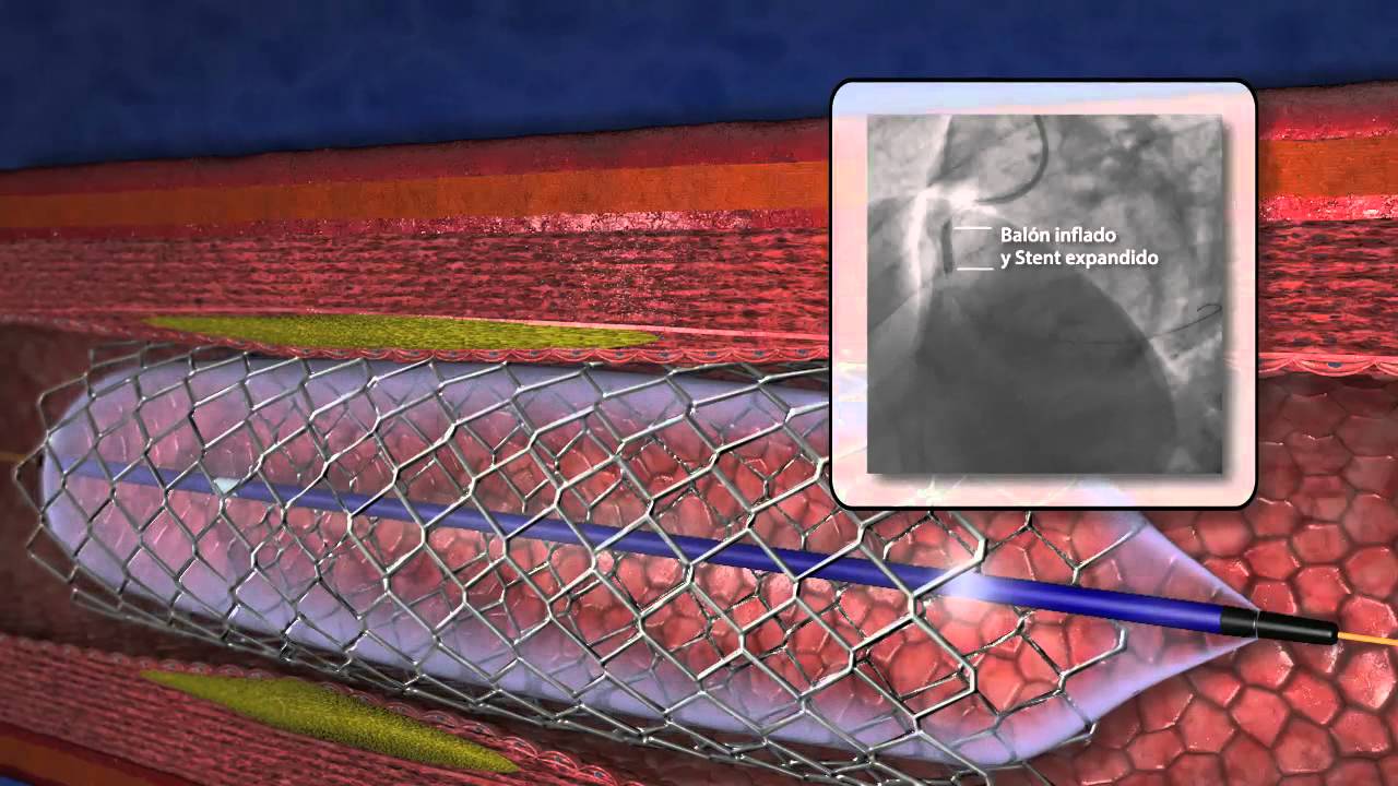 Angioplastia coronaria - YouTube