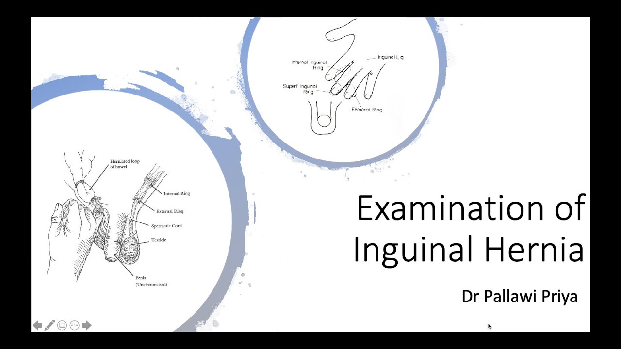 Clinical examination of Hernia - YouTube