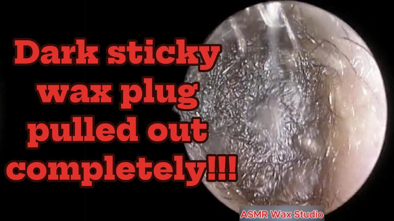 Dark sticky wax plug pulled out completely | ASMR clean | relax ...