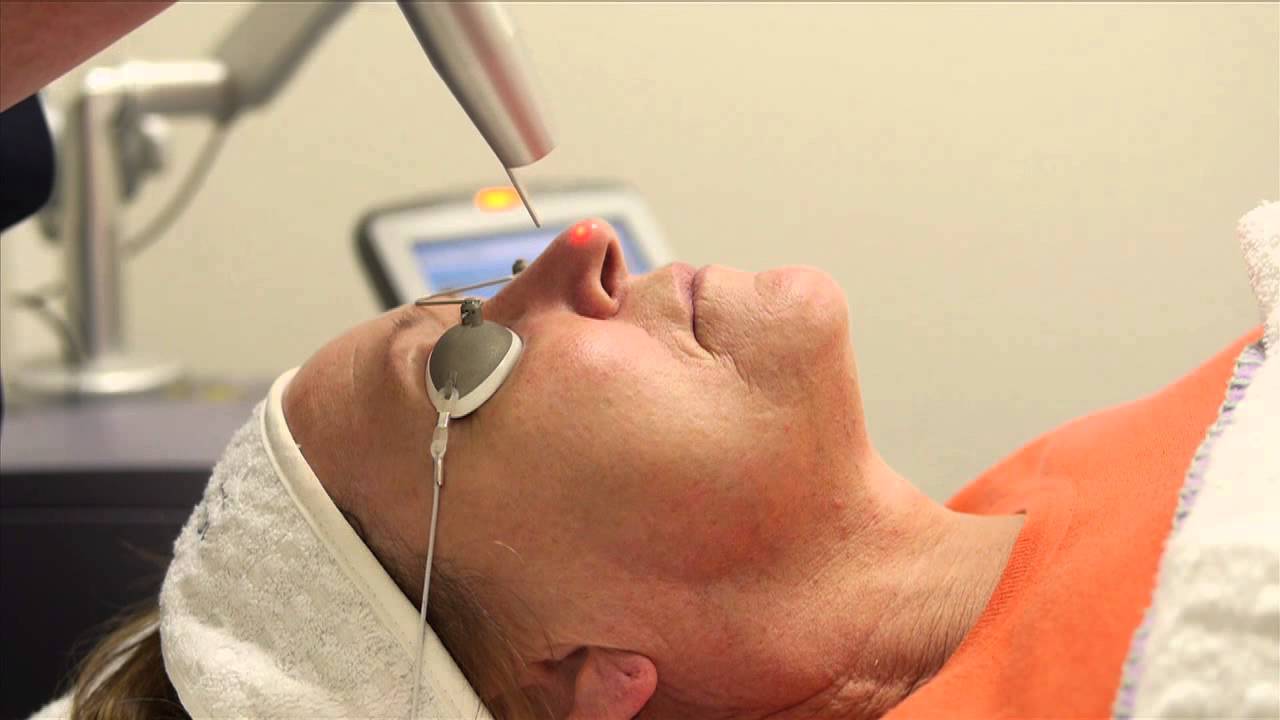 Laser Skin Rejuvenation at Andrea Catton Laser Clinic - YouTube