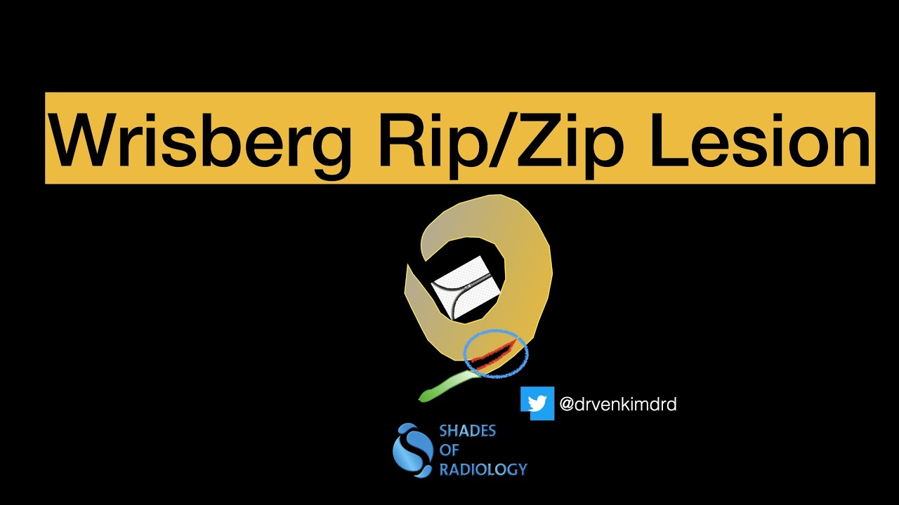 Wrisberg Rip/Zip lesion of Lateral meniscus - YouTube