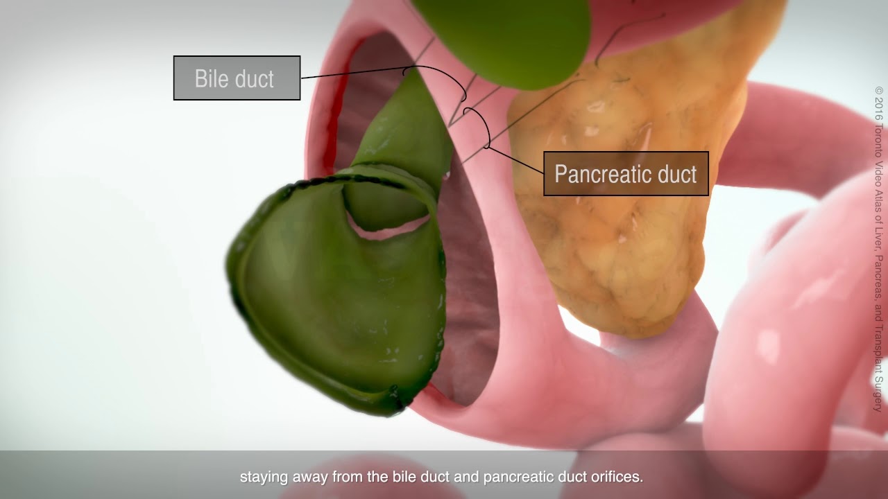 Resection of type III choledochal cyst - YouTube