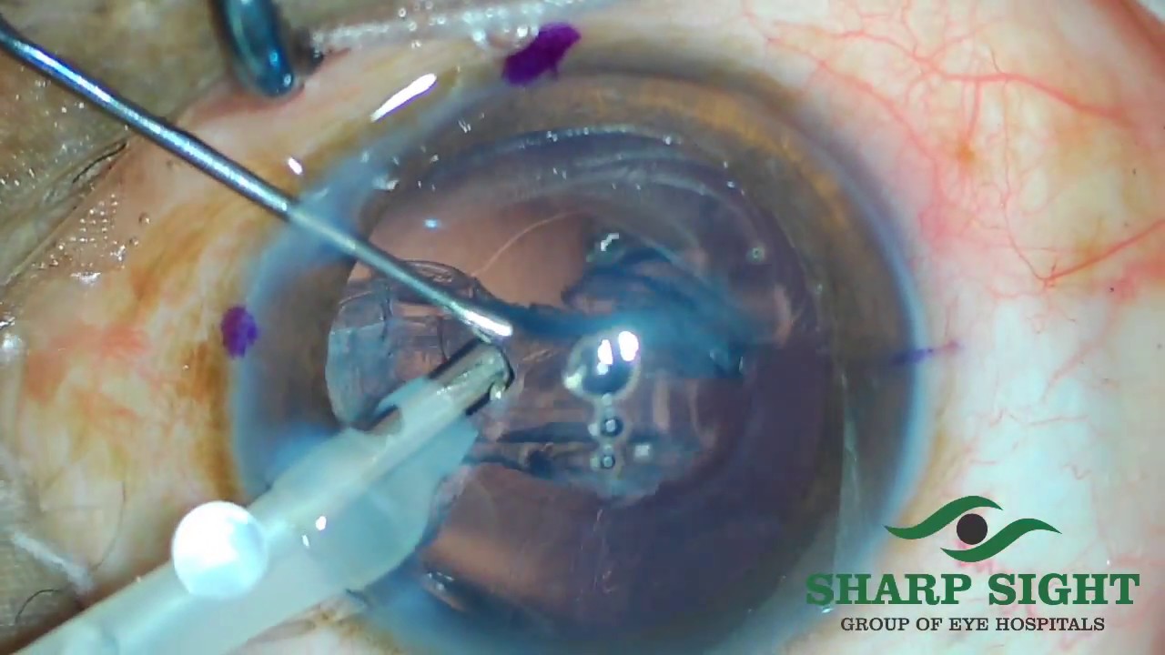 Smart toric of 13 5 d cylinder managing soft cataract - YouTube