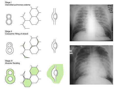 20190409 pulmonary edema and acute lung injury - YouTube