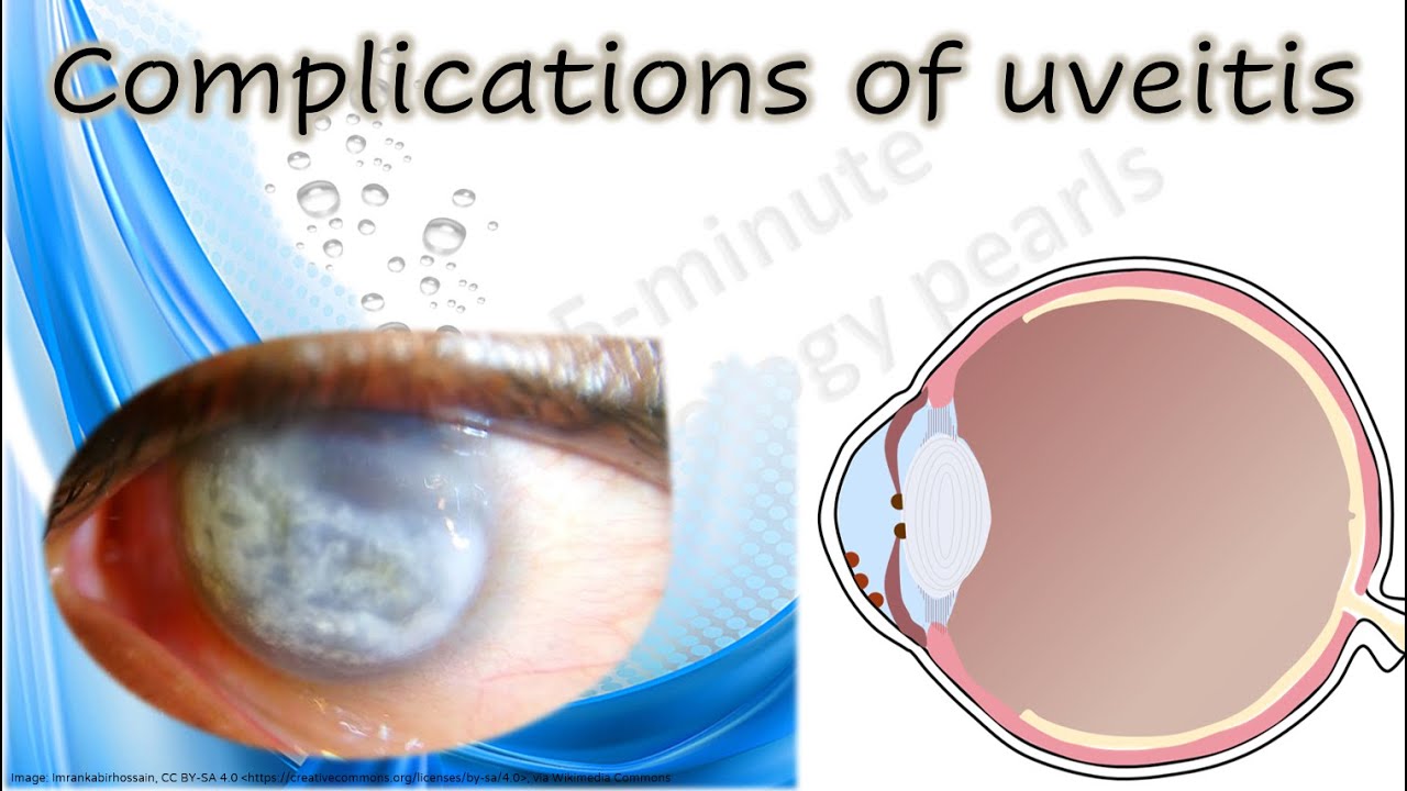 Complications of uveitis - YouTube