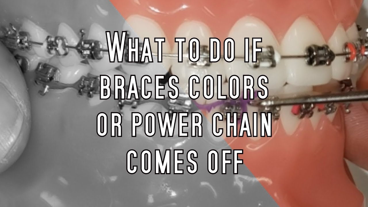 What to do if braces colors or power chain comes off - YouTube