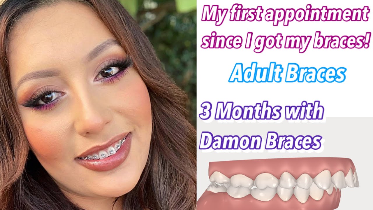 3 Month Braces Update Damon Braces Overjet Overbite Adult Braces