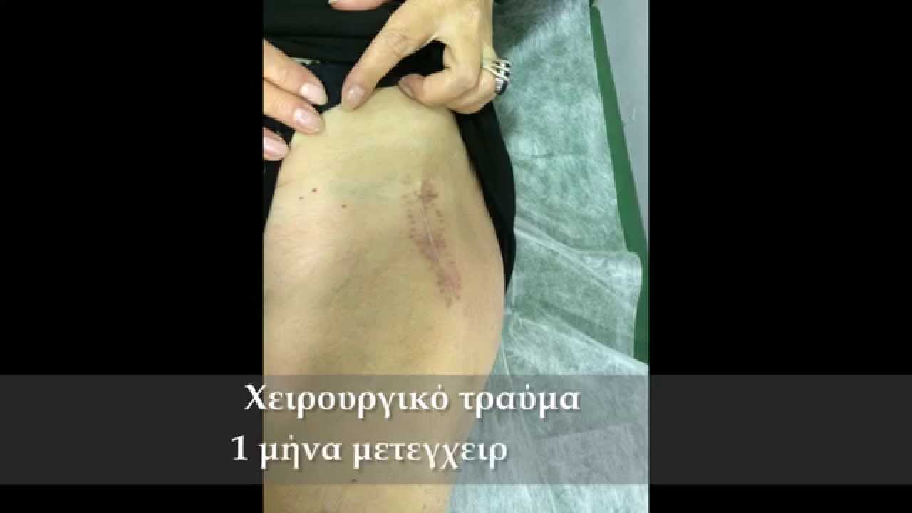 Ολική αρθροπλαστική ισχίου ελάχιστης επεμβατικότητας ALMIS - Δρ. Ν ...