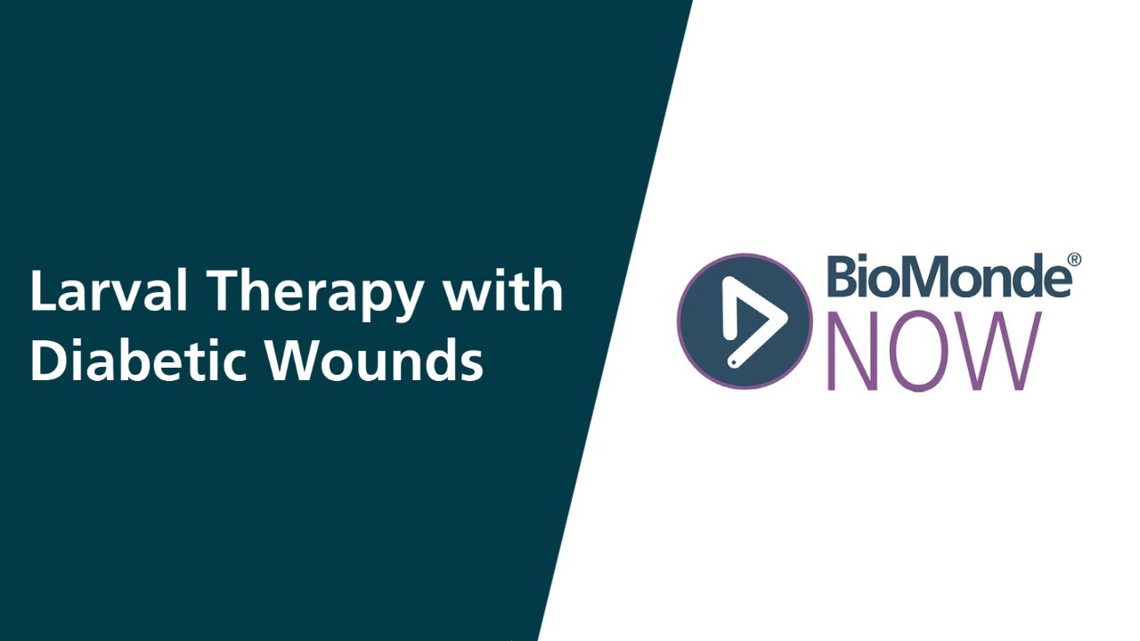 Larval Therapy with Diabetic Wounds | Wound Care Case Study - YouTube