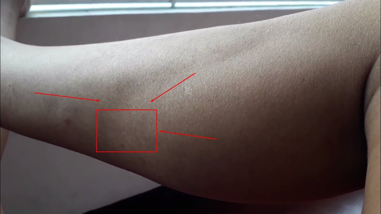 Fasciculaciones 2. Más intensas. - YouTube