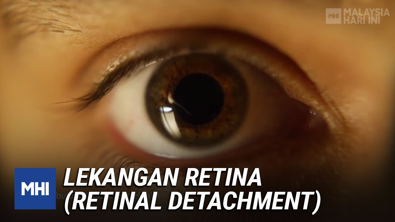 Lekangan Retina (Retinal Detachment) Bhg 1 | MHI (8 Februari 2021 ...
