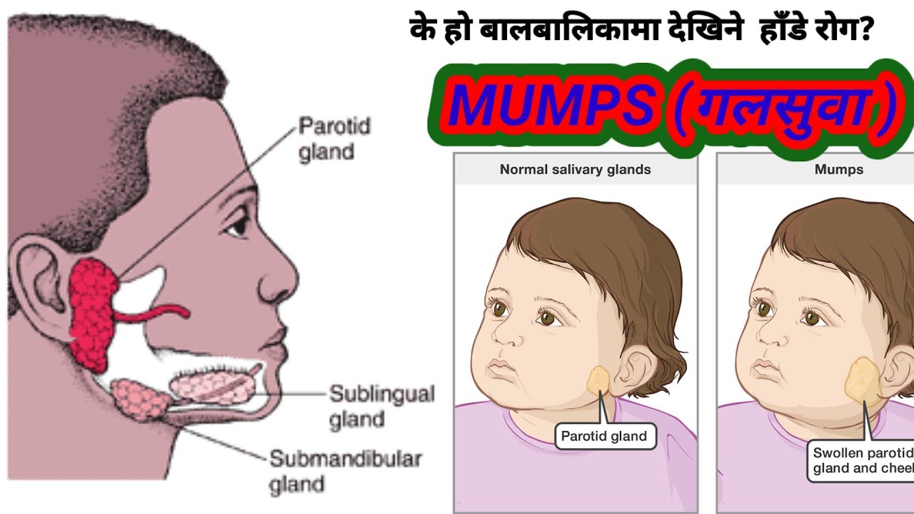 Mumps disease in Nepali हाडे रोग,गल्सुवा, गल्सोत,गलफु ( Mumps Treatment ...