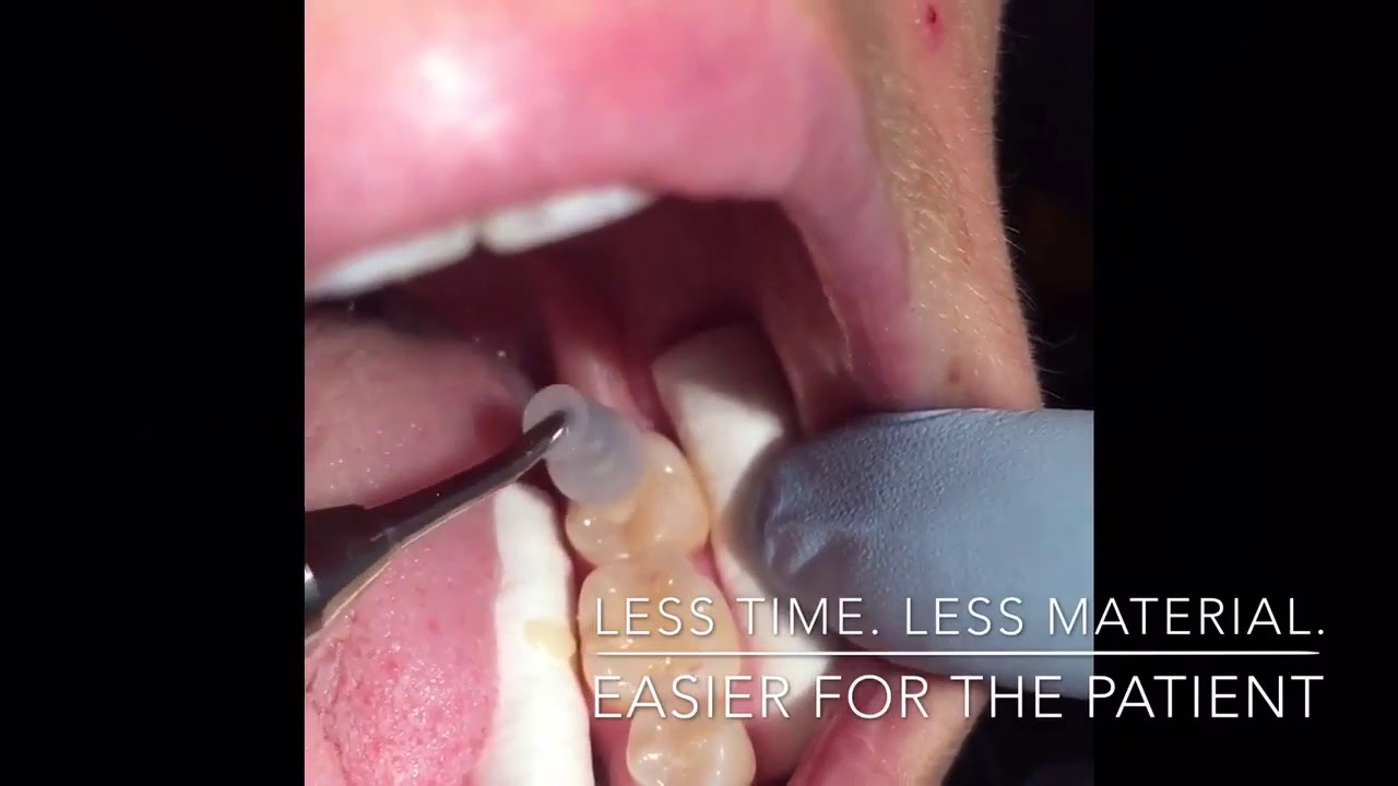 Compressing Composite: the new technique is placing composite fillings ...
