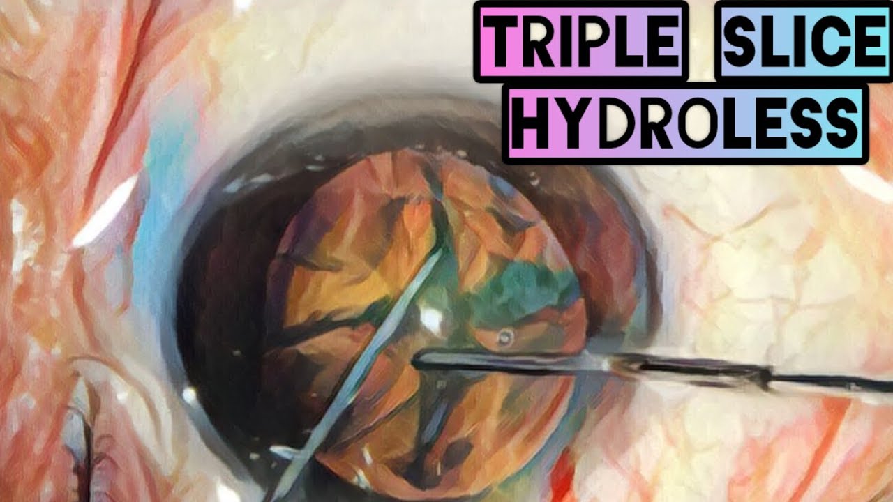 #tripleslice technique #hydroless #cataractsurgery - YouTube