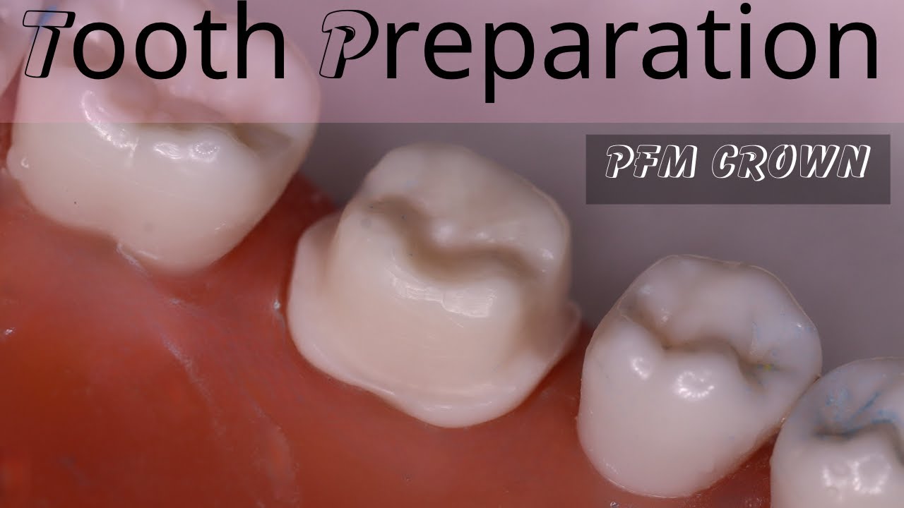 Tooth Preparation for PFM Crown 🔵 Now live streaming ⚪️ Step By Step ...