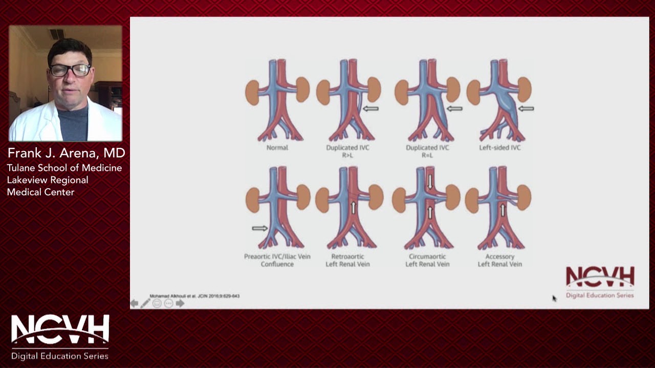 Dr. Frank Arena, How to Manage IVC Thrombosis - YouTube