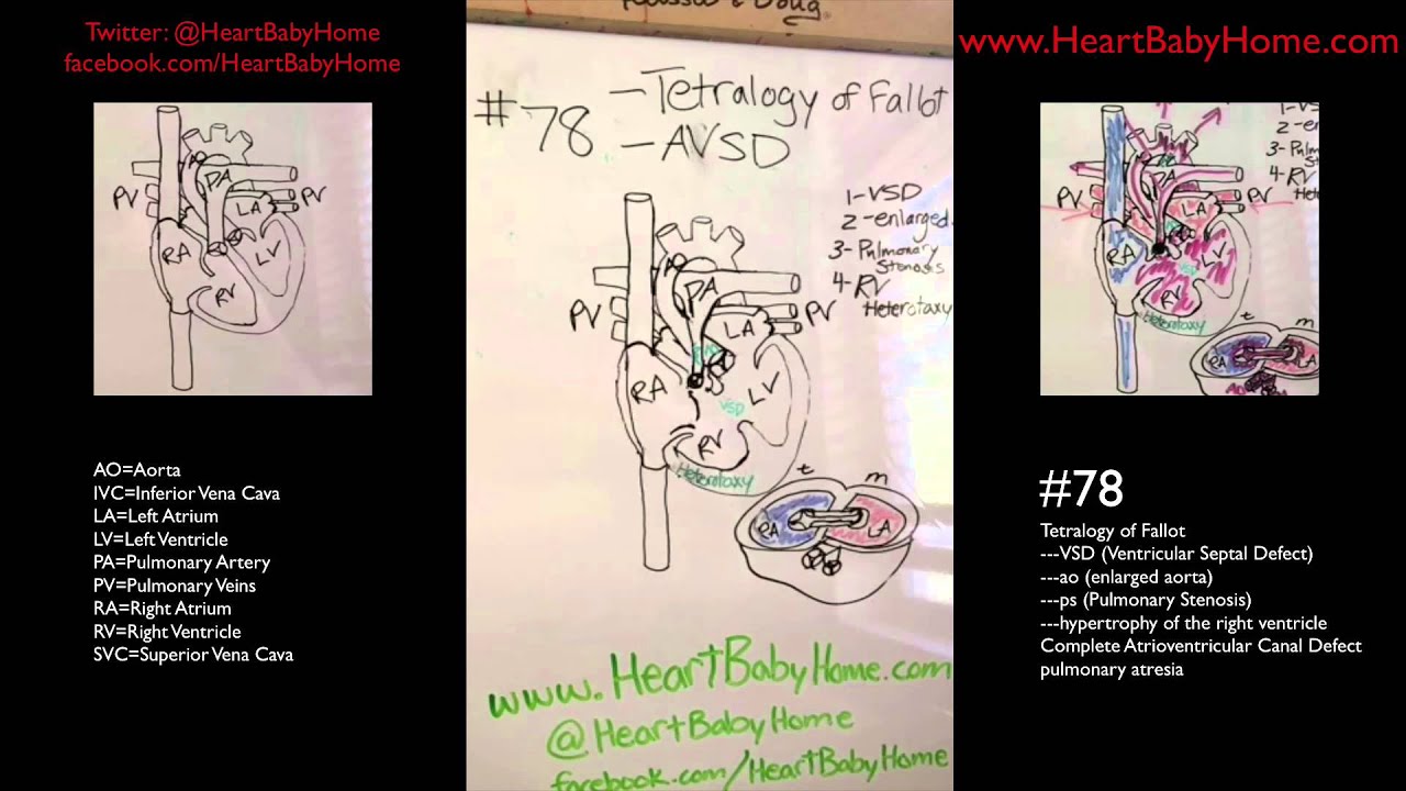 Heart Defect #78 - ToF, CAVC, pulmonary stenosis - YouTube