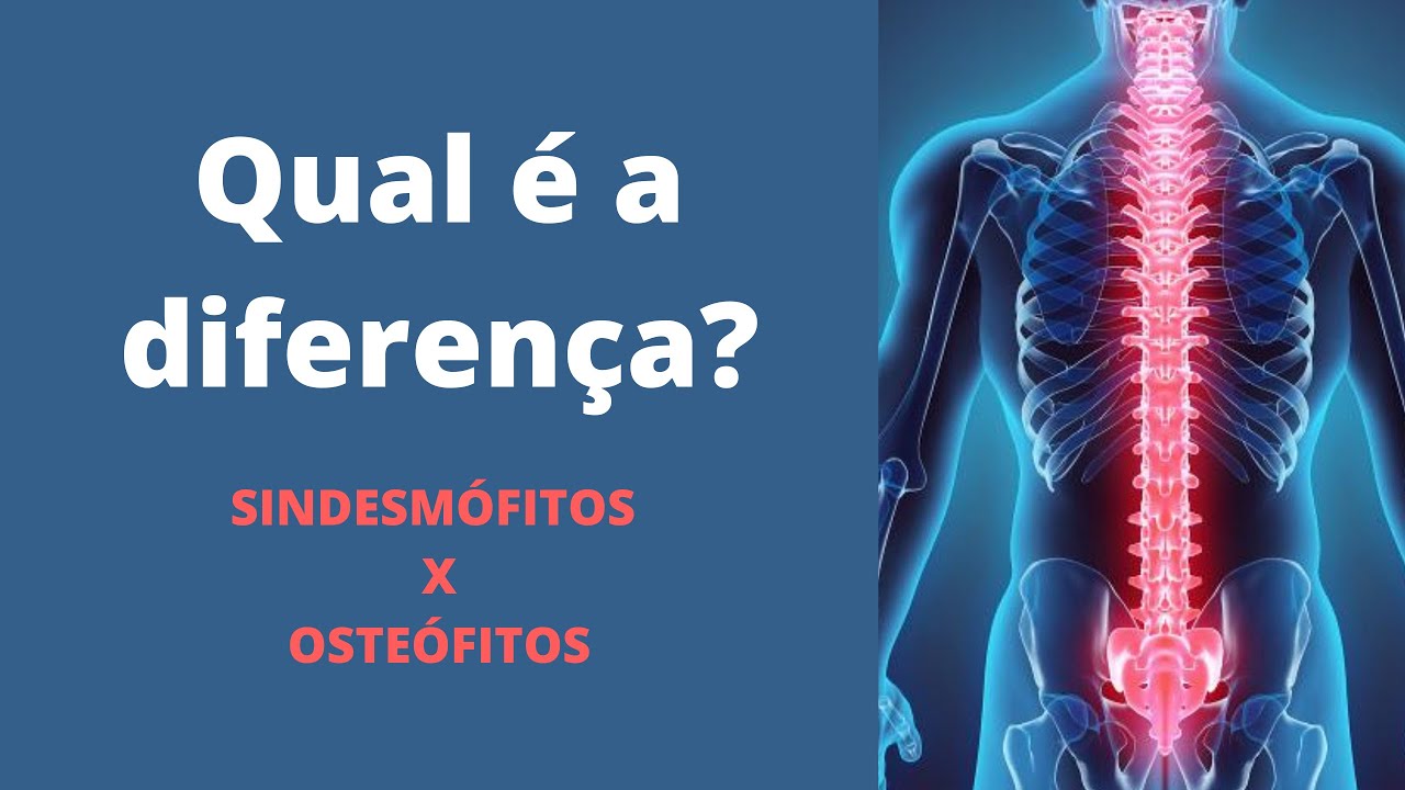 Sindesmófitos X Osteófitos | FisioEdu Retondaro - YouTube