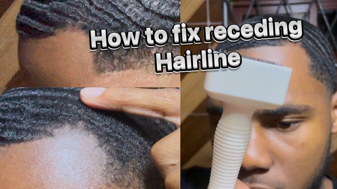 How to fix receding hairline - YouTube