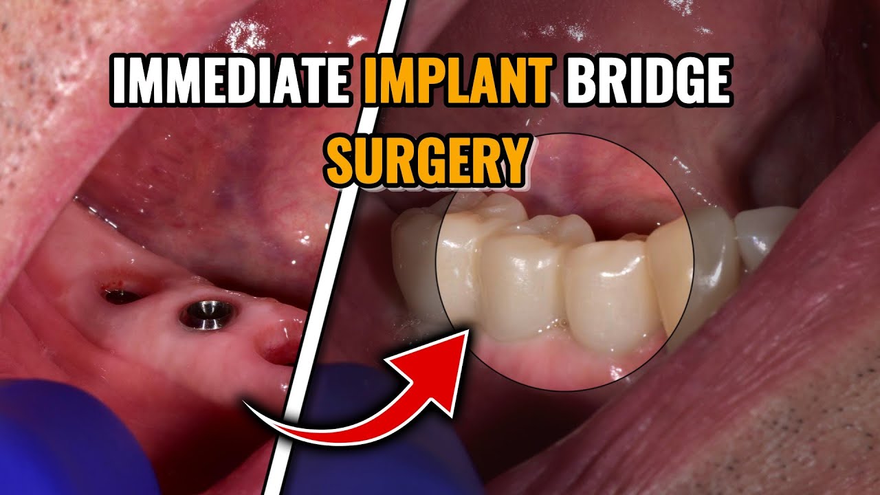 [77] Dental Implant Bridge - Surgery and Install - YouTube