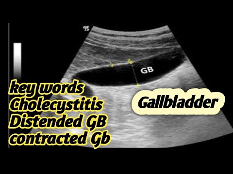 cholecystitis|Contracted GB|Radiology Vibes - YouTube