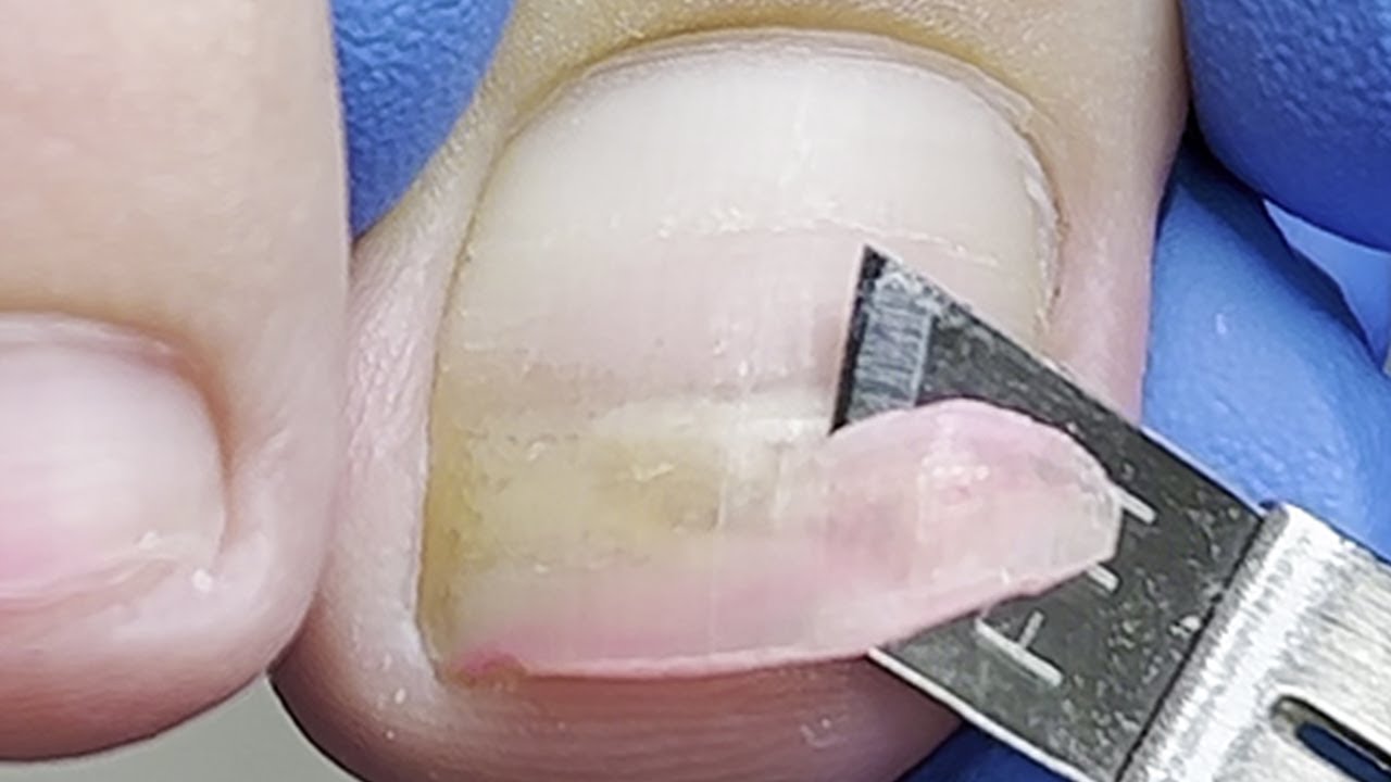 Stinking toenails that haven't been trimmed for too long【Xue Yidao ...