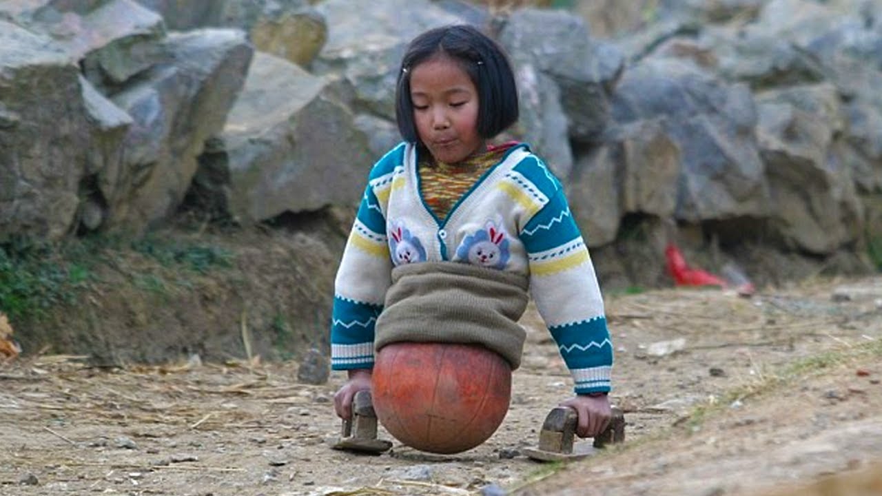 This girl has a BASKETBALL for LEGS! Amazing story - YouTube