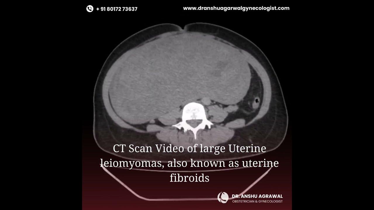 Ct Scan Video Of Large Uterine Leiomyomas Also Known As Uterine