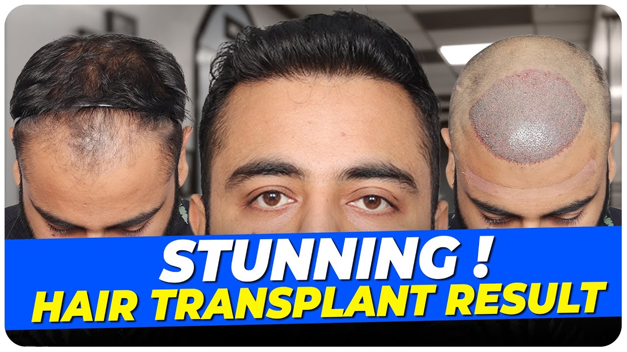 Hair Transplant in Hubli | Best Results & Cost of Hair Transplant in ...