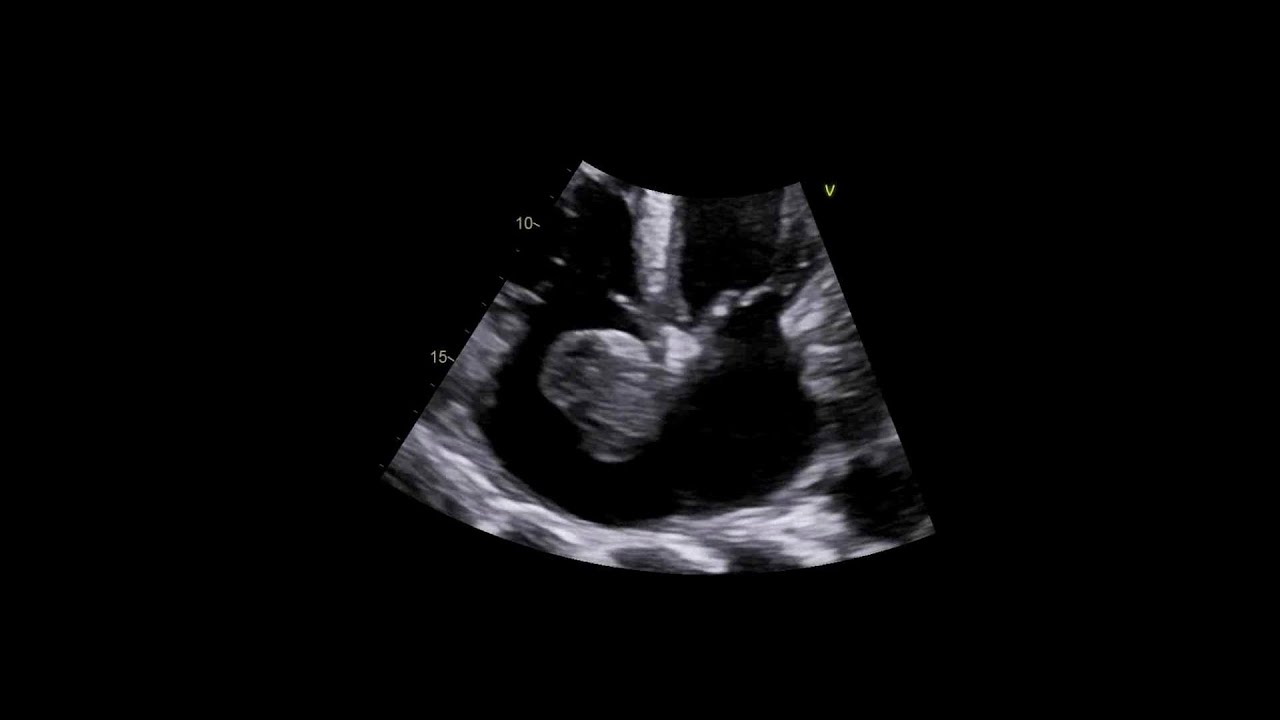 Primary Cardiac Synovial Sarcoma - YouTube