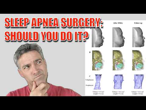 Maxillomandibular Advancement Surgery (MMA) for Sleep Apnea: Worth It ...