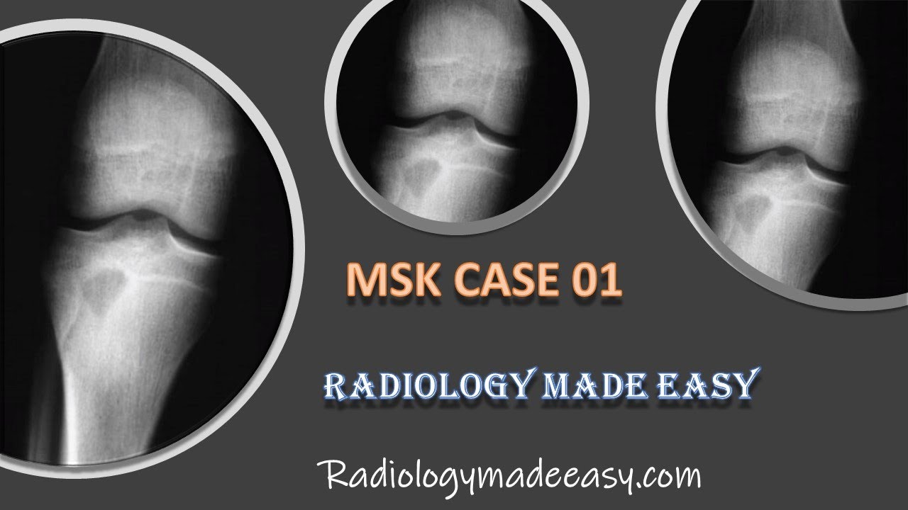 A 18 years old male presented with right knee pain | FRCR MSK case 01 ...
