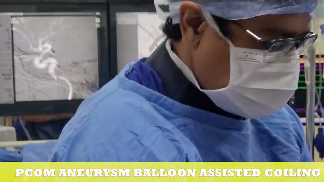 Balloon Assisted PCOM Aneurysm Coiling - YouTube