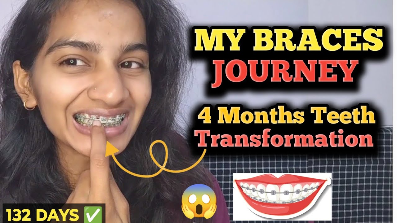 My Teeth Then vs. Now : 4 Months Braces Update - YouTube