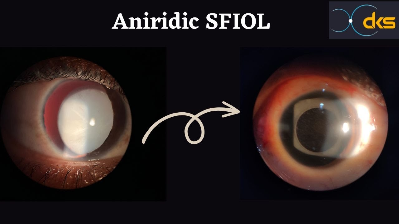 Aniridic SFIOL, the answer to aphakic photophobia | Vitrectomy ...