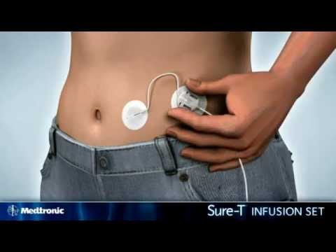 (EN) Inserting the MiniMed Sure-T Infusion Set - YouTube