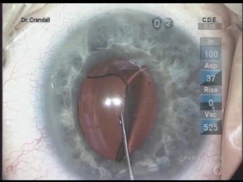 IOL Fold - YouTube