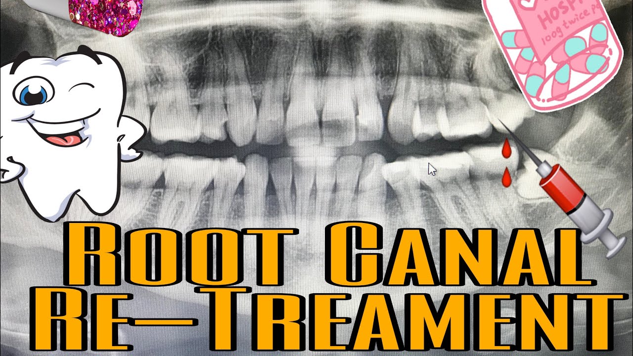 my RE-RCT TREATMENT | 1st Visit - YouTube