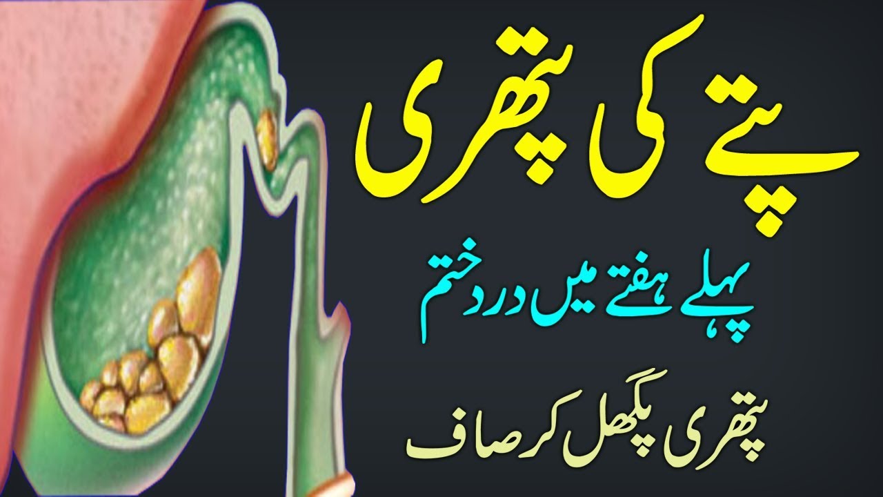 GallStone Treatment Without Surgery || Pittay ki Pathri ki ilaj In ...